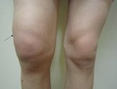 Meniscus Injury: Torn Knee Cartilage