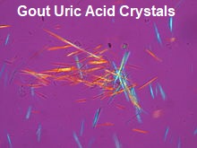 Gout Knee: Causes, Symptoms & Treatment - Knee Pain Explained