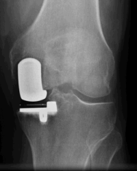 Knee Replacement Recovery, Rehab & Success Rates