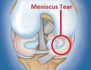 Meniscus Cartilage