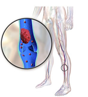 Pain Behind The Knee: Common Causes & Treatment - Knee Pain Explained