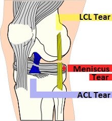 Twisted Knee: Common Injuries & Treatment - Knee Pain Explained