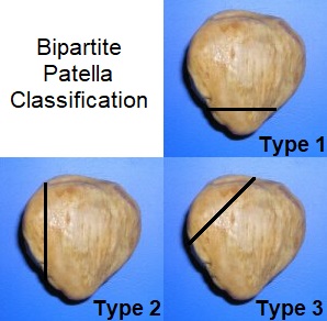 Bipartite Patella - Knee Pain Explained