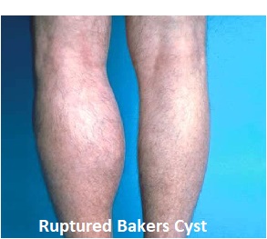 Calf Muscle Pain: Causes & Treatment - Knee Pain Explained