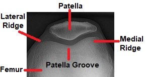 Dislocated Patella / Kneecap - Knee Pain Explained