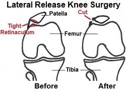 Dislocated Patella / Kneecap - Knee Pain Explained
