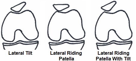 Lateral Release Knee Surgery - Knee Pain Explained