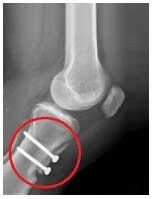 Dislocated Patella / Kneecap - Knee Pain Explained